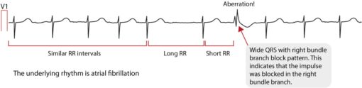 Fibrillation auriculaire : électrocardiogramme, classification ...