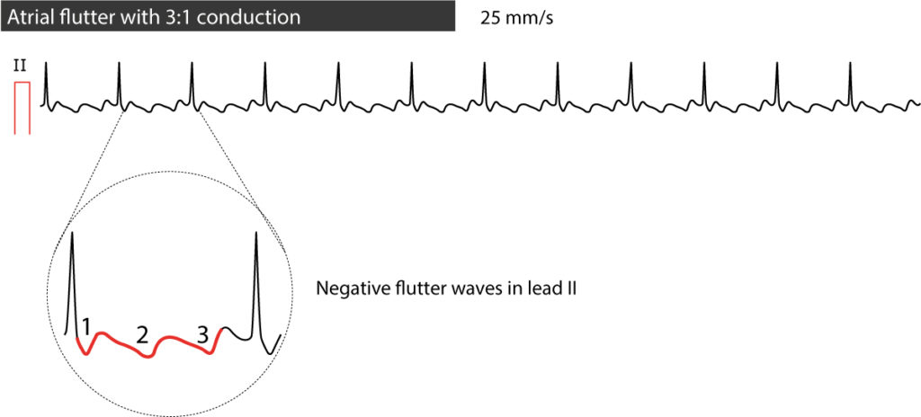 Flutter auriculaire : classification, causes, critères ECG et prise en ...