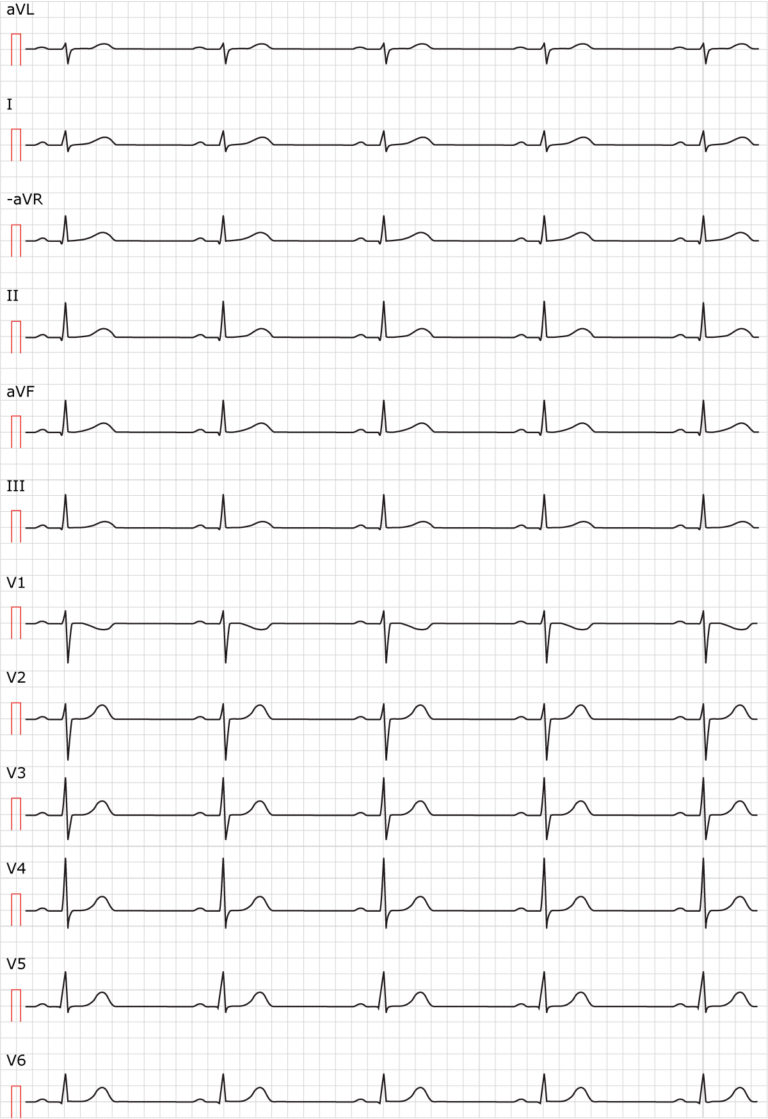 Rythme sinusal : physiologie, critères électrocardiographiques et ...