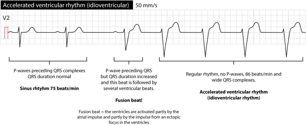 Rythme Ventriculaire Et Rythme Idioventriculaire Accéléré Médecine