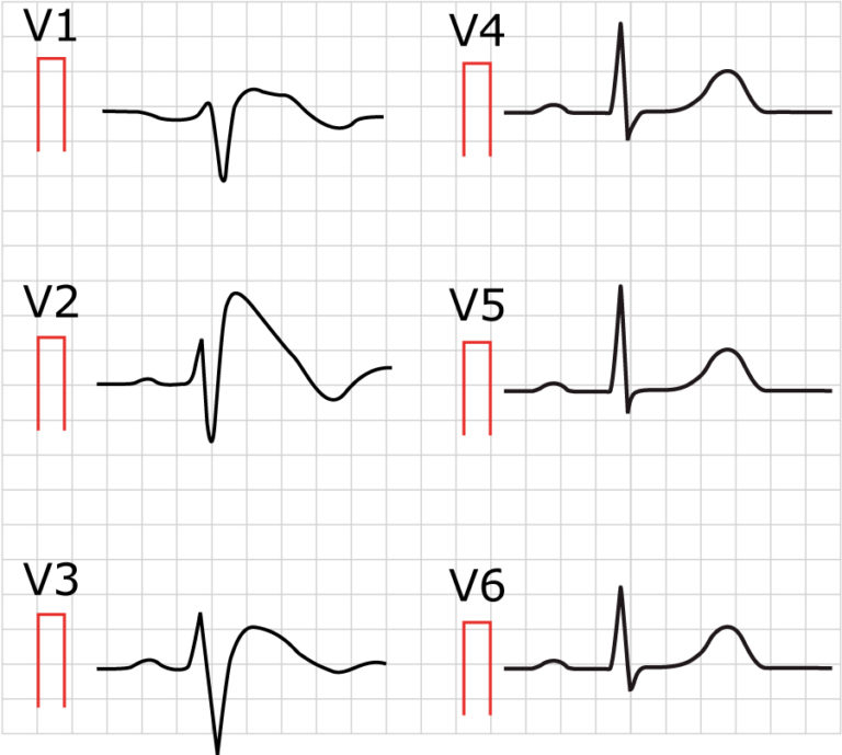 Syndromes de l'onde J de l'ECG : hypothermie, repolarisation précoce ...