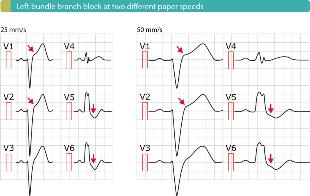 Infarctus du myocarde avec sus-décalage du segment ST (STEMI) sans sus ...
