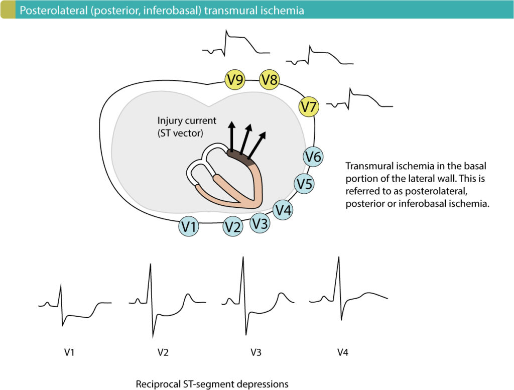 Infarctus du myocarde avec sus-décalage du segment ST (STEMI) sans sus ...