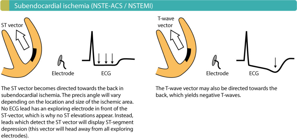 ECG en cas d'ischémie myocardique : modifications ischémiques du ...
