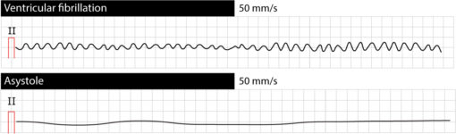 Fibrillation ventriculaire, activité électrique sans pouls et arrêt ...
