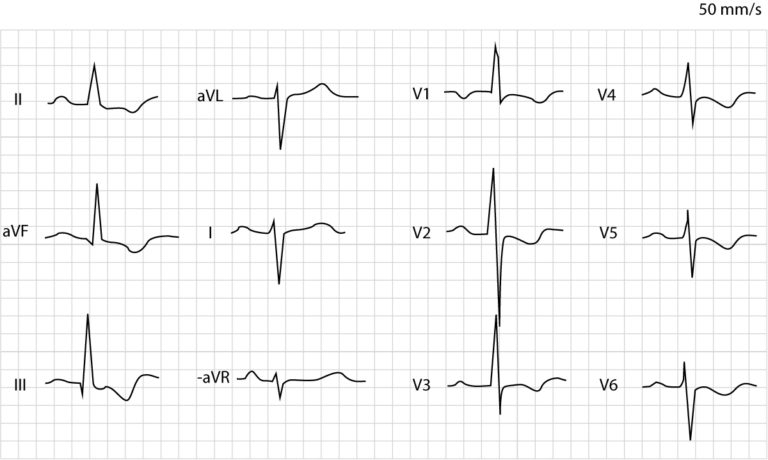 Infarctus du myocarde avec sus-décalage du segment ST (STEMI) sans sus ...
