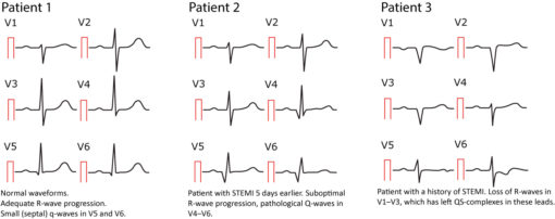 Le complexe QRS : caractéristiques ECG de l'onde Q, de l'onde R, de l ...