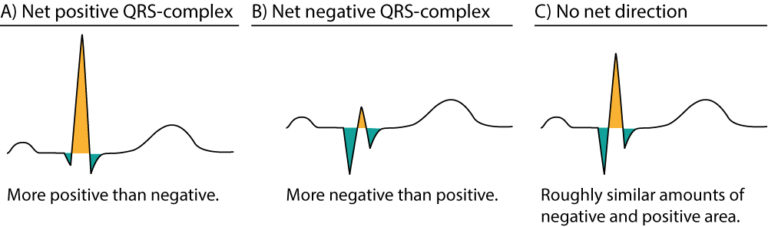 Le complexe QRS : caractéristiques ECG de l'onde Q, de l'onde R, de l'onde S et de leur durée
