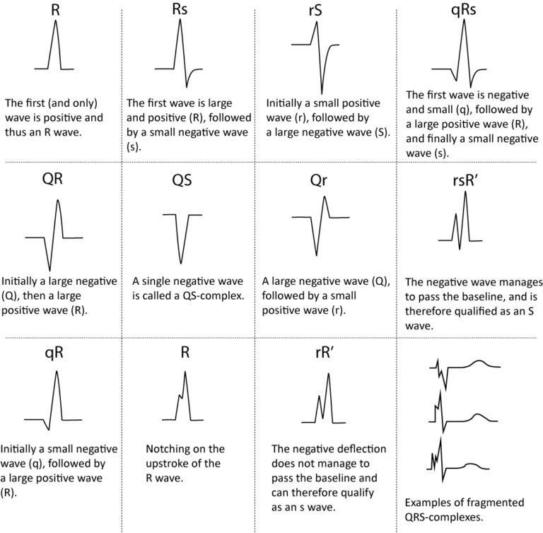 Le complexe QRS : caractéristiques ECG de l'onde Q, de l'onde R, de l'onde S et de leur durée