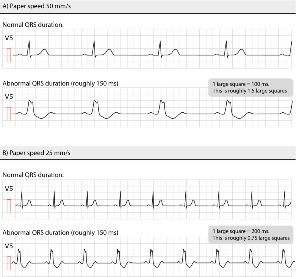 Le complexe QRS : caractéristiques ECG de l'onde Q, de l'onde R, de l ...