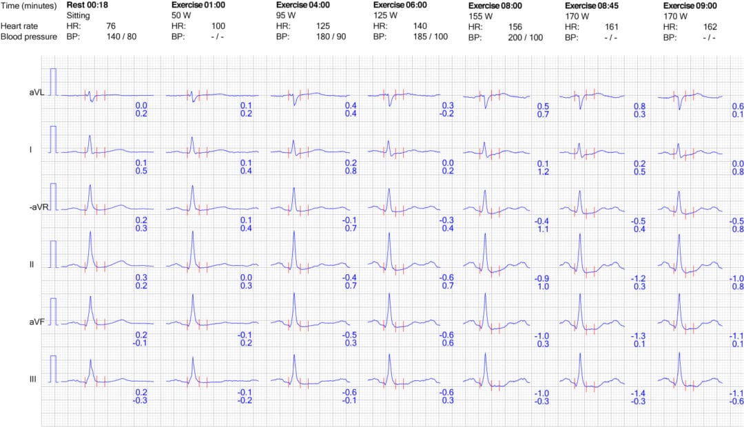 Évaluation de l'épreuve d'effort : ECG, symptômes, pression artérielle ...