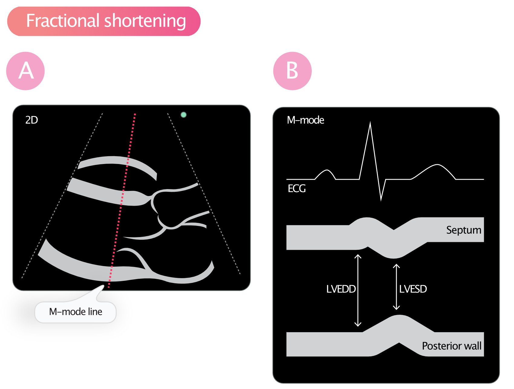 Raccourcissement fractionnel pour l'estimation de la fraction d'éjection – Médecine Cardiovasculaire