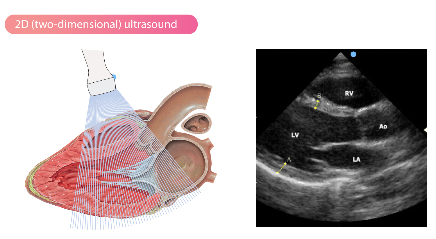 Échocardiographie bidimensionnelle (2D) – Médecine Cardiovasculaire