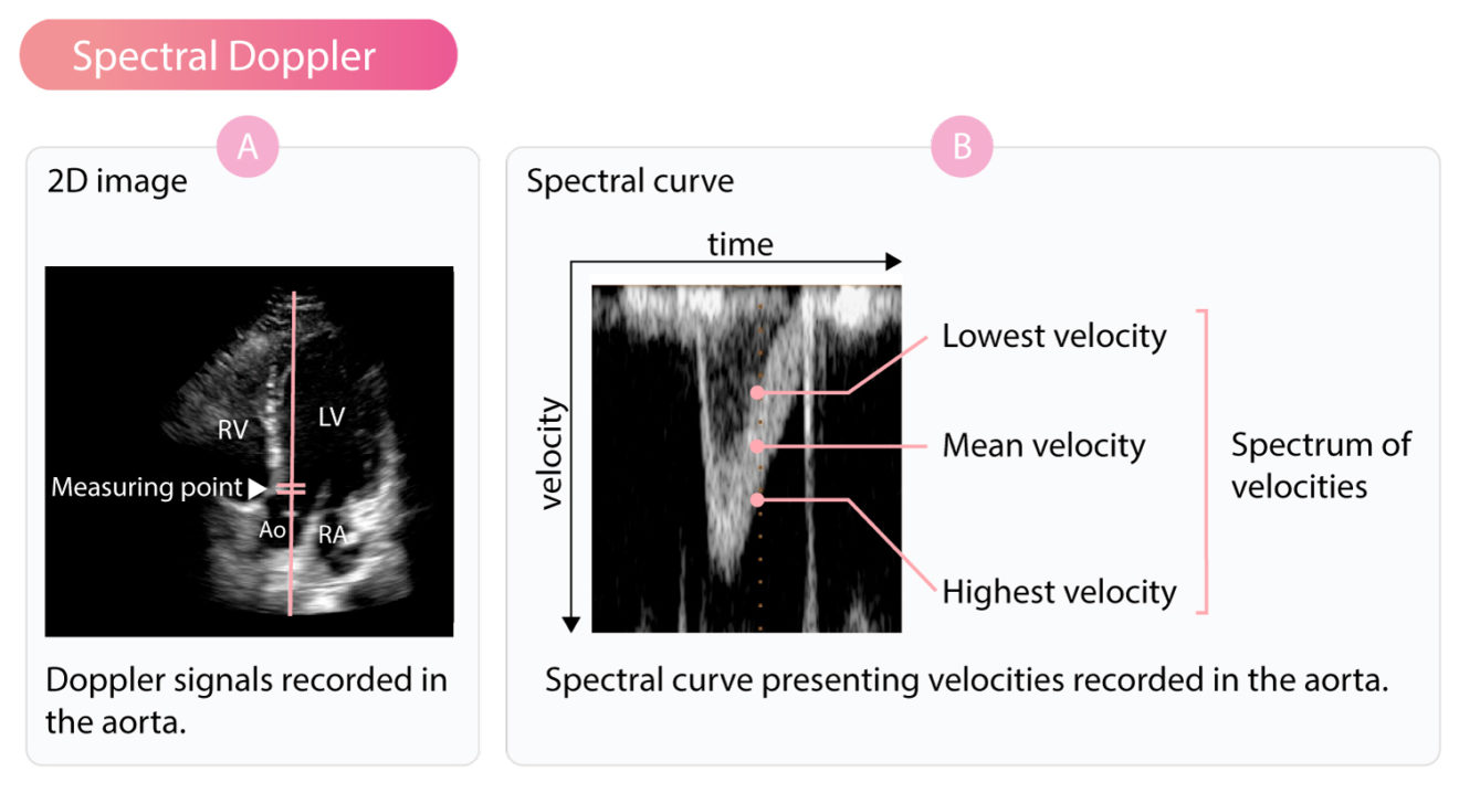 Effet Doppler et échocardiographie Doppler – Médecine Cardiovasculaire