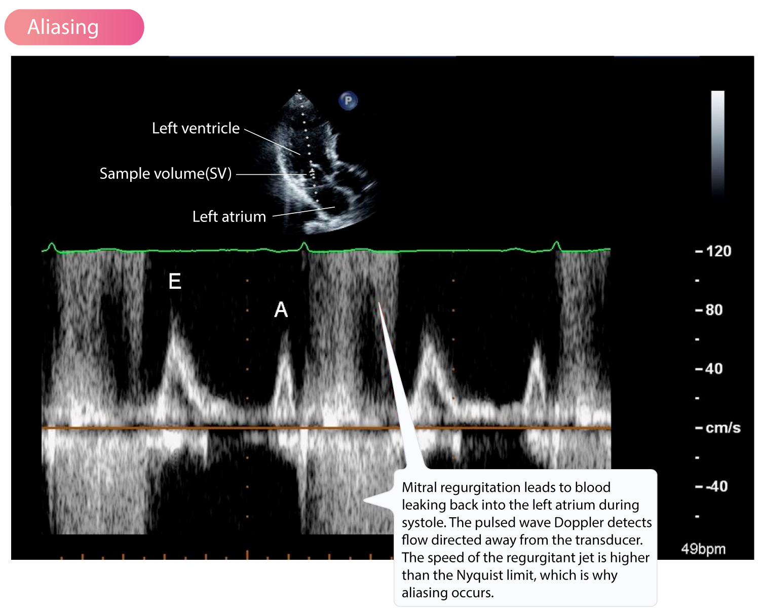 Doppler Ondes Puls es M decine Cardiovasculaire doppler-ondes-puls-es-m-decine-cardiovasculaire