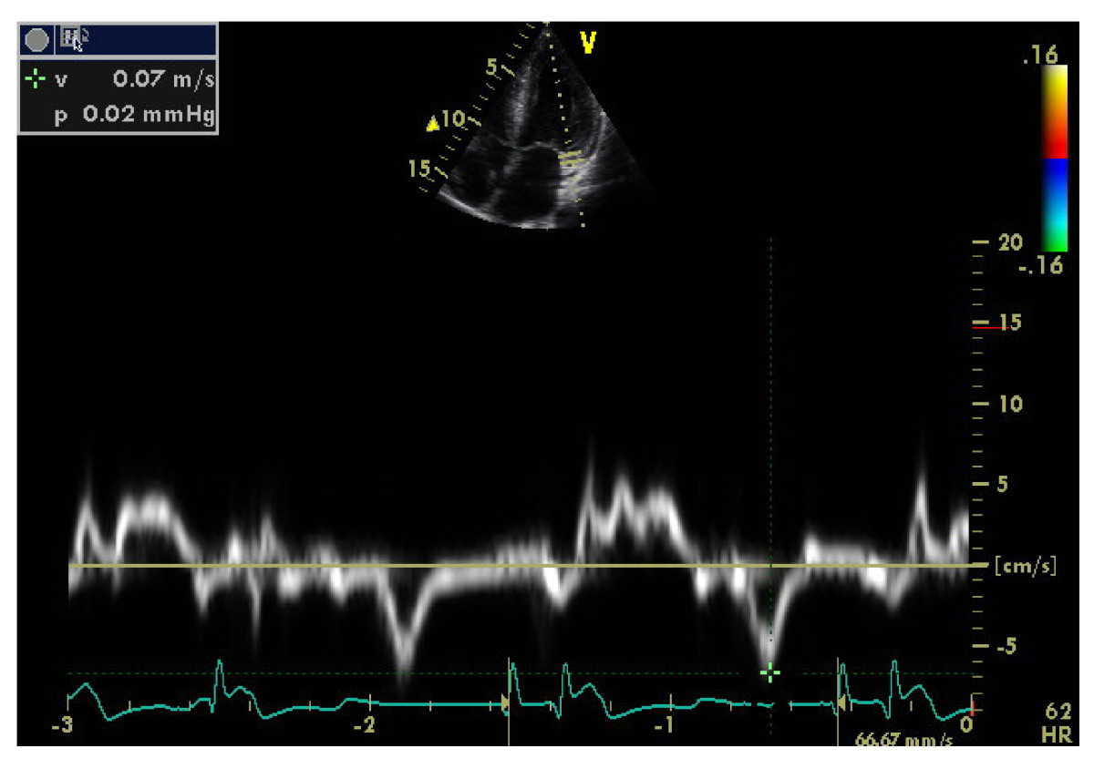 Doppler tissulaire (imagerie de vélocité tissulaire) – Médecine ...