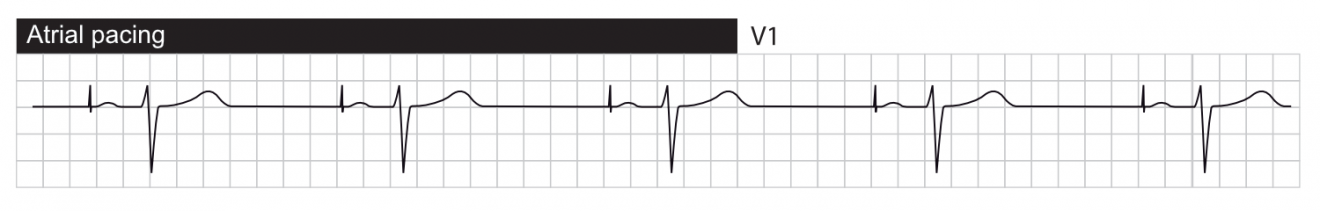 Interprétation de l'ECG du stimulateur cardiaque – Médecine ...