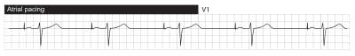 Interprétation de l'ECG du stimulateur cardiaque – Médecine ...