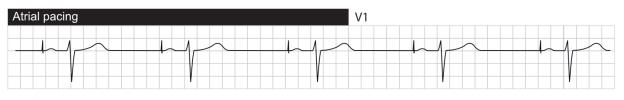 Interprétation de l'ECG du stimulateur cardiaque – Médecine ...
