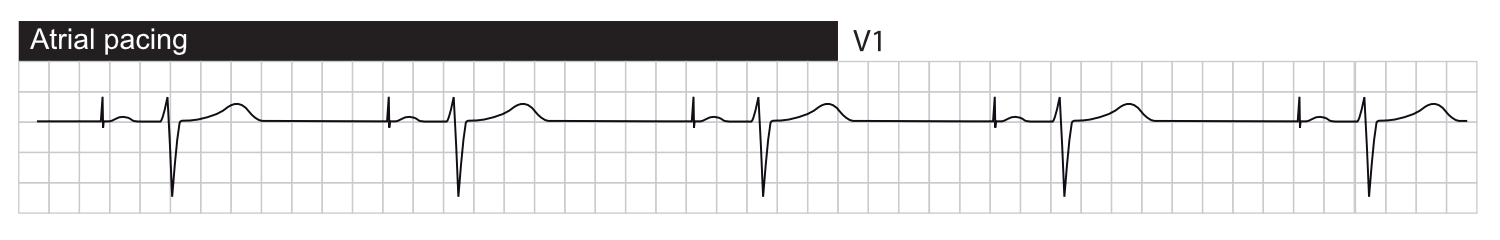 Interprétation de l'ECG du stimulateur cardiaque – Médecine ...