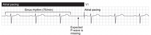Interprétation de l'ECG du stimulateur cardiaque – Médecine ...