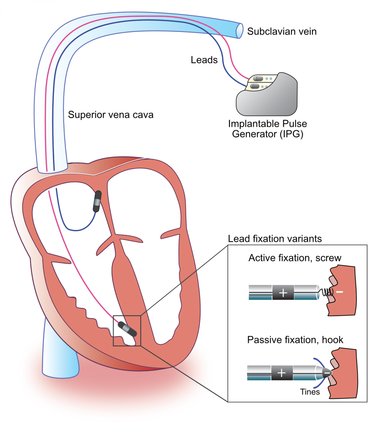 Composants et construction d'un stimulateur cardiaque – Médecine ...