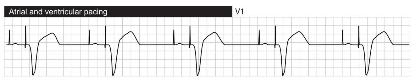 Interprétation de l'ECG du stimulateur cardiaque – Médecine ...