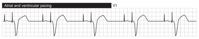 Interprétation de l'ECG du stimulateur cardiaque – Médecine ...