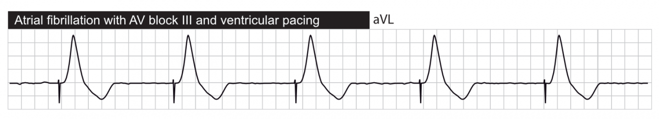 Interprétation de l'ECG du stimulateur cardiaque – Médecine ...