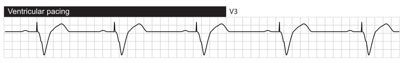 Interprétation de l'ECG du stimulateur cardiaque – Médecine ...