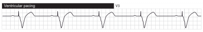 Interprétation de l'ECG du stimulateur cardiaque – Médecine ...