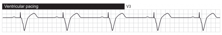Interprétation de l'ECG du stimulateur cardiaque – Médecine ...