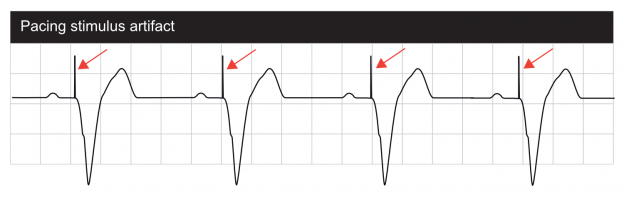 Composants et construction d'un stimulateur cardiaque – Médecine ...