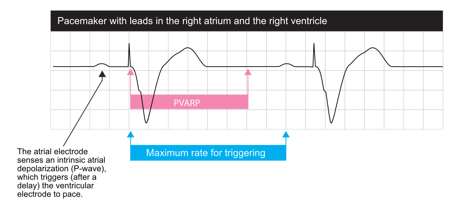 Stimulation cardiaque de base, fonctions et réglages des stimulateurs cardiaques – The ...