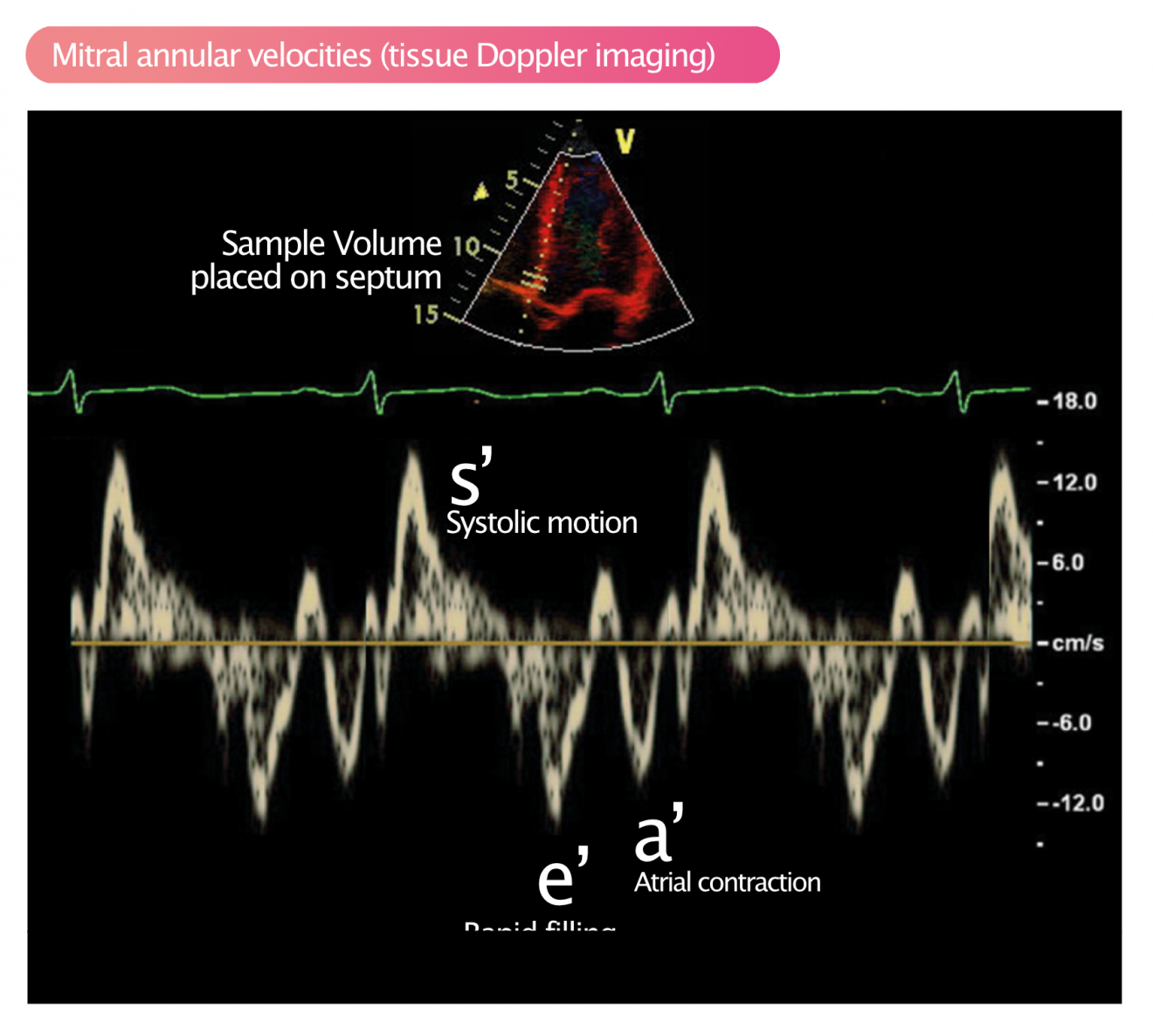 Évaluation de la fonction diastolique par échocardiographie – Médecine ...
