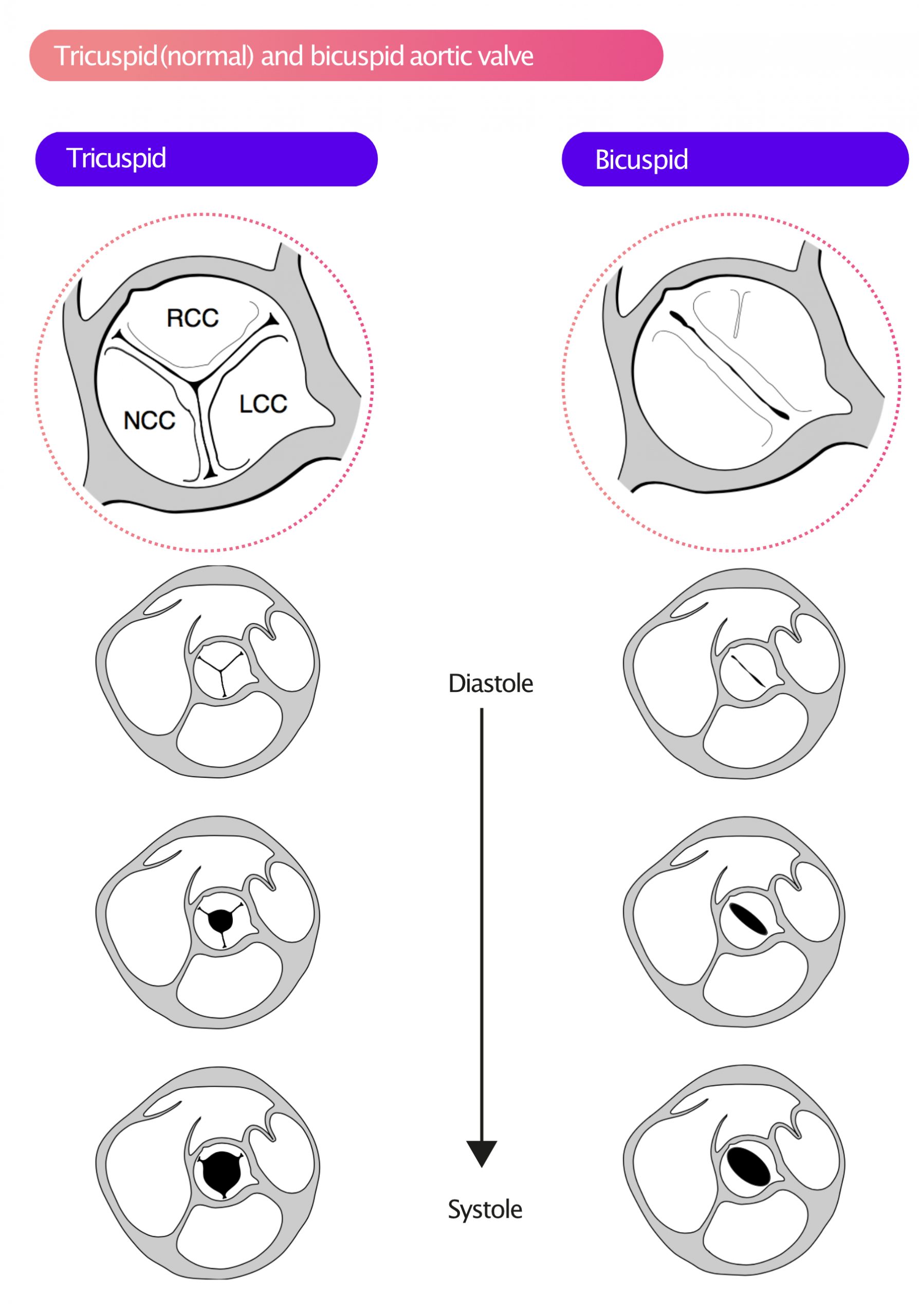 Sténose aortique - Echocardiographie, diagnostic, classification ...