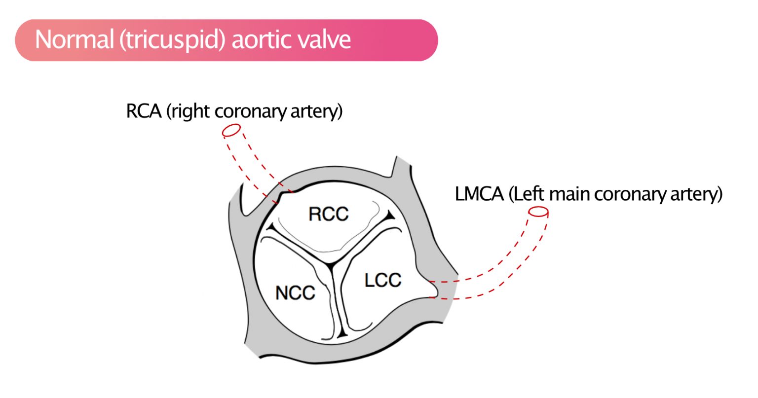 Sténose aortique - Echocardiographie, diagnostic, classification ...