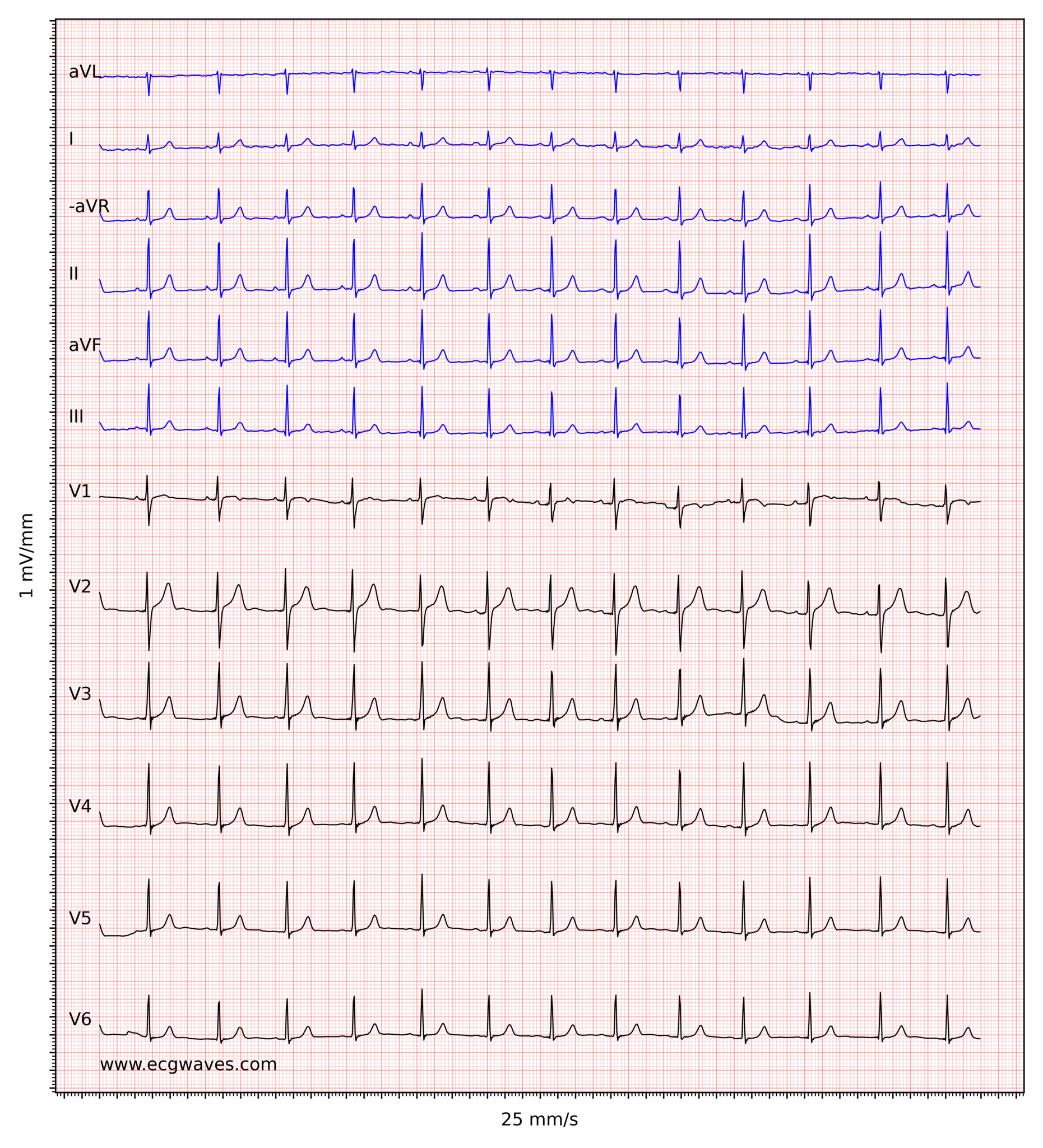 Interprétation de l’ECG : caractéristiques d’un tracé ...