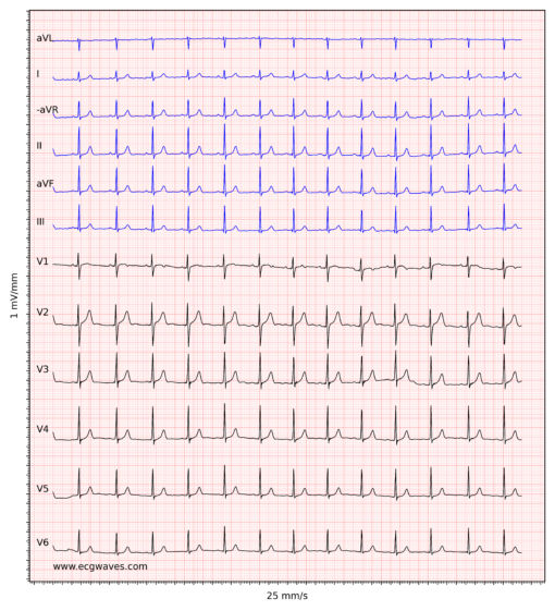 Interprétation de l’ECG : caractéristiques d’un tracé ...
