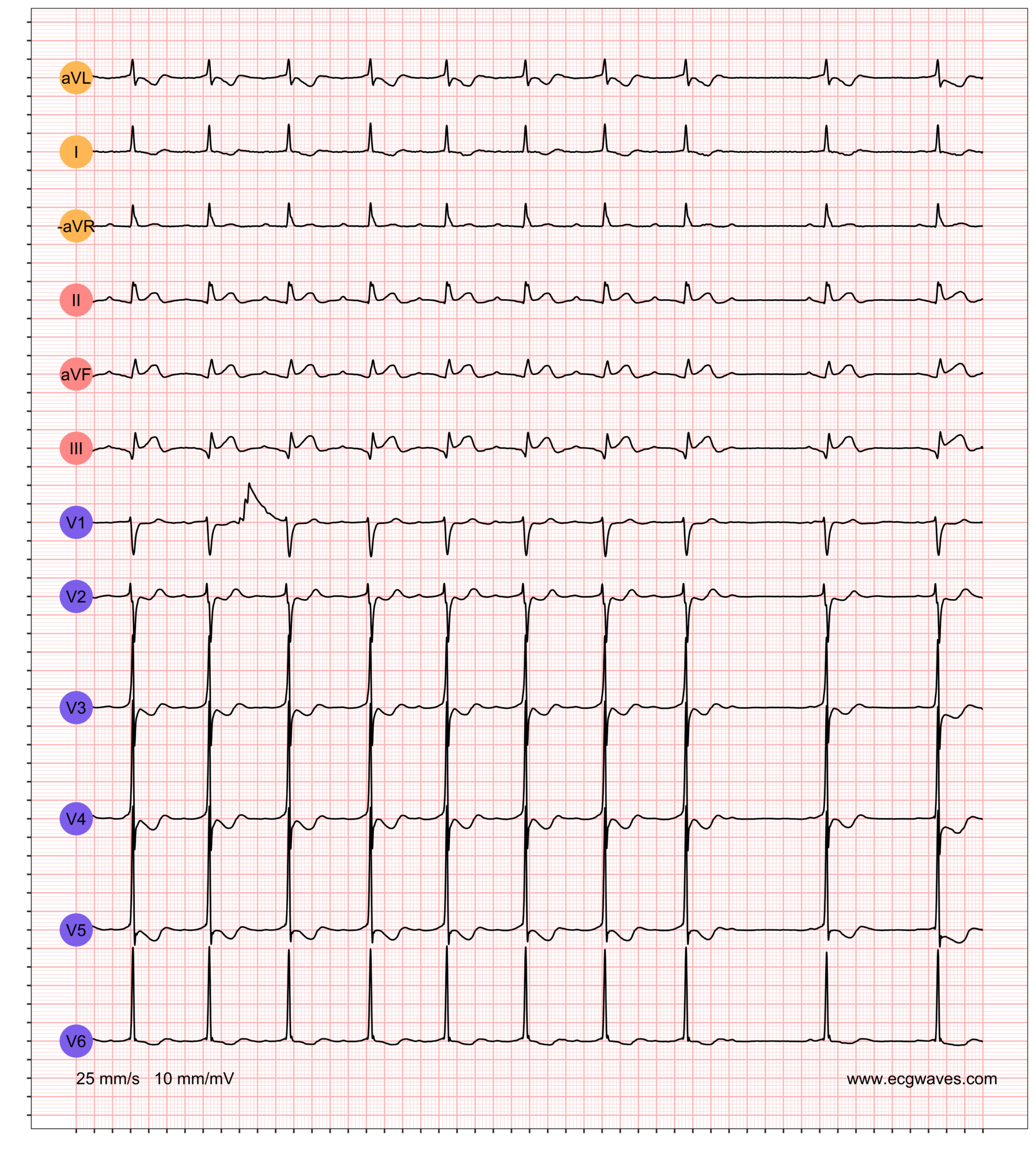 Bloc AV du second degré : Bloc de Mobitz de type 1 (Wenckebach) et bloc ...