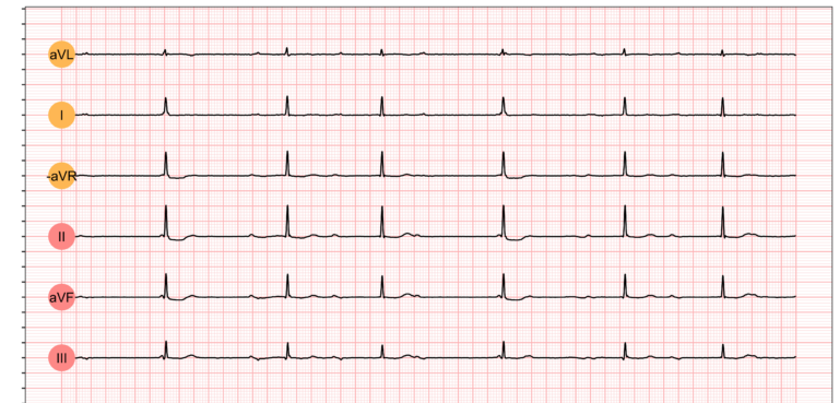 Bloc AV du troisième degré (bloc AV du troisième degré, bloc AV 3, bloc ...