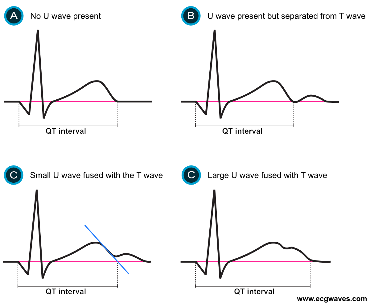 Durée du QT et durée du QT corrigé (QTc) : Caractéristiques et implications de l'ECG