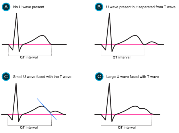 Intervalle QT long (QTc), syndrome du QT long (LQTS) et torsades de ...