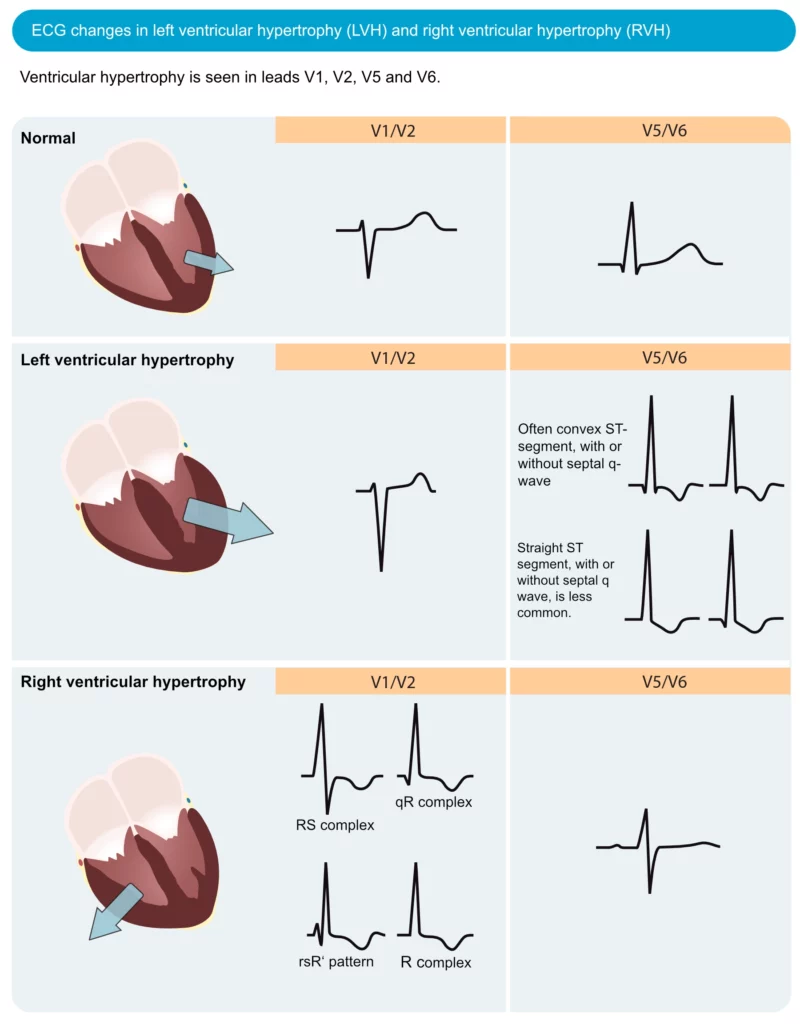 ECG Dans L hypertrophie Ventriculaire Gauche HVG Crit res Et ECG Dans L hypertrophie Ventriculaire Gauche HVG Crit res Et