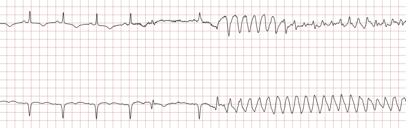 Fibrillation ventriculaire, activité électrique sans pouls et arrêt ...