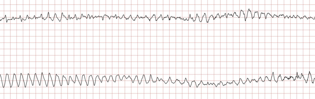 Fibrillation ventriculaire, activité électrique sans pouls et arrêt ...