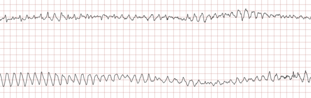 Fibrillation ventriculaire, activité électrique sans pouls et arrêt ...