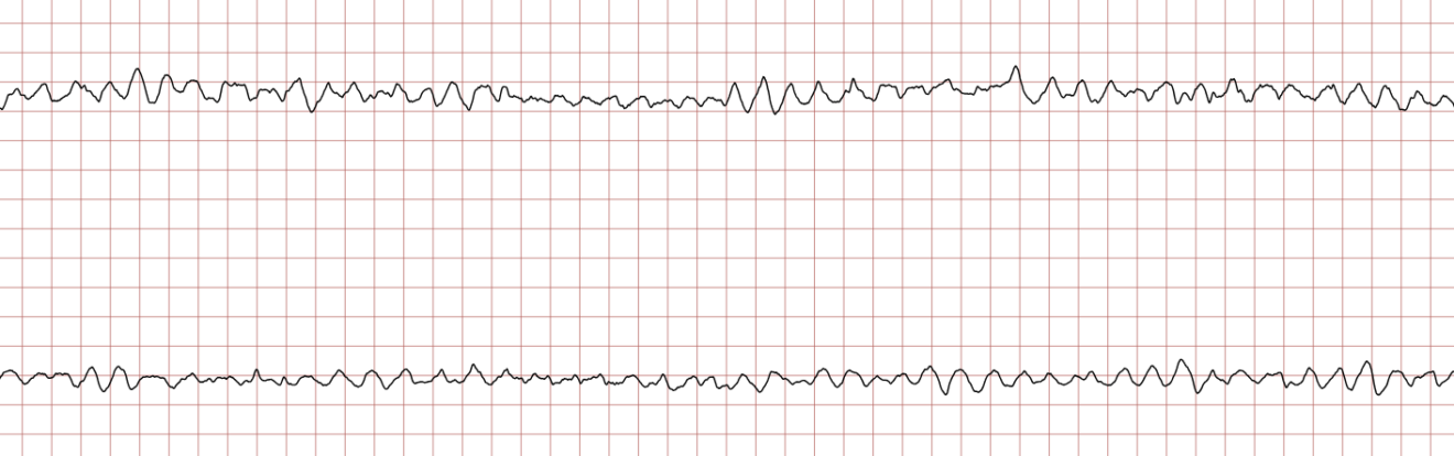 Tachycardie ventriculaire (TV) : critères électrocardiographiques ...