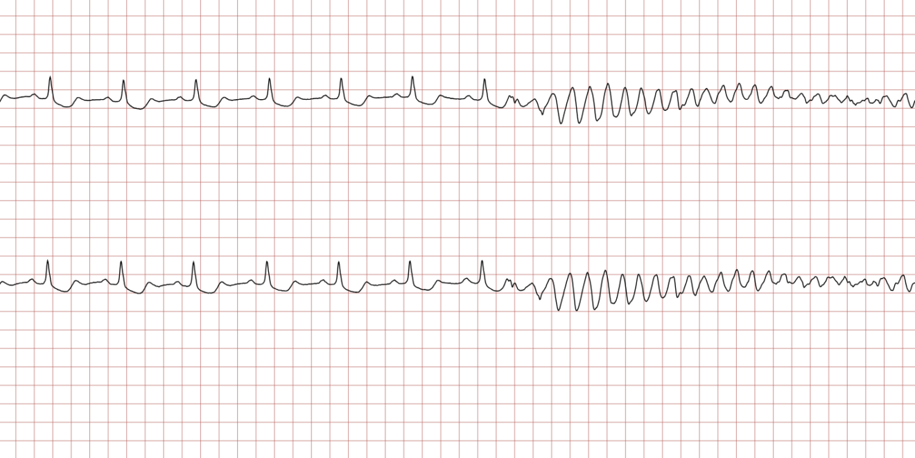 Fibrillation ventriculaire, activité électrique sans pouls et arrêt ...