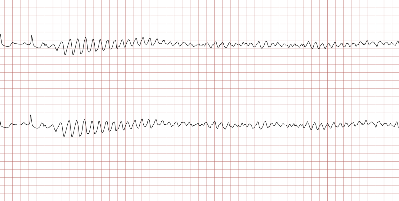 Fibrillation ventriculaire, activité électrique sans pouls et arrêt ...